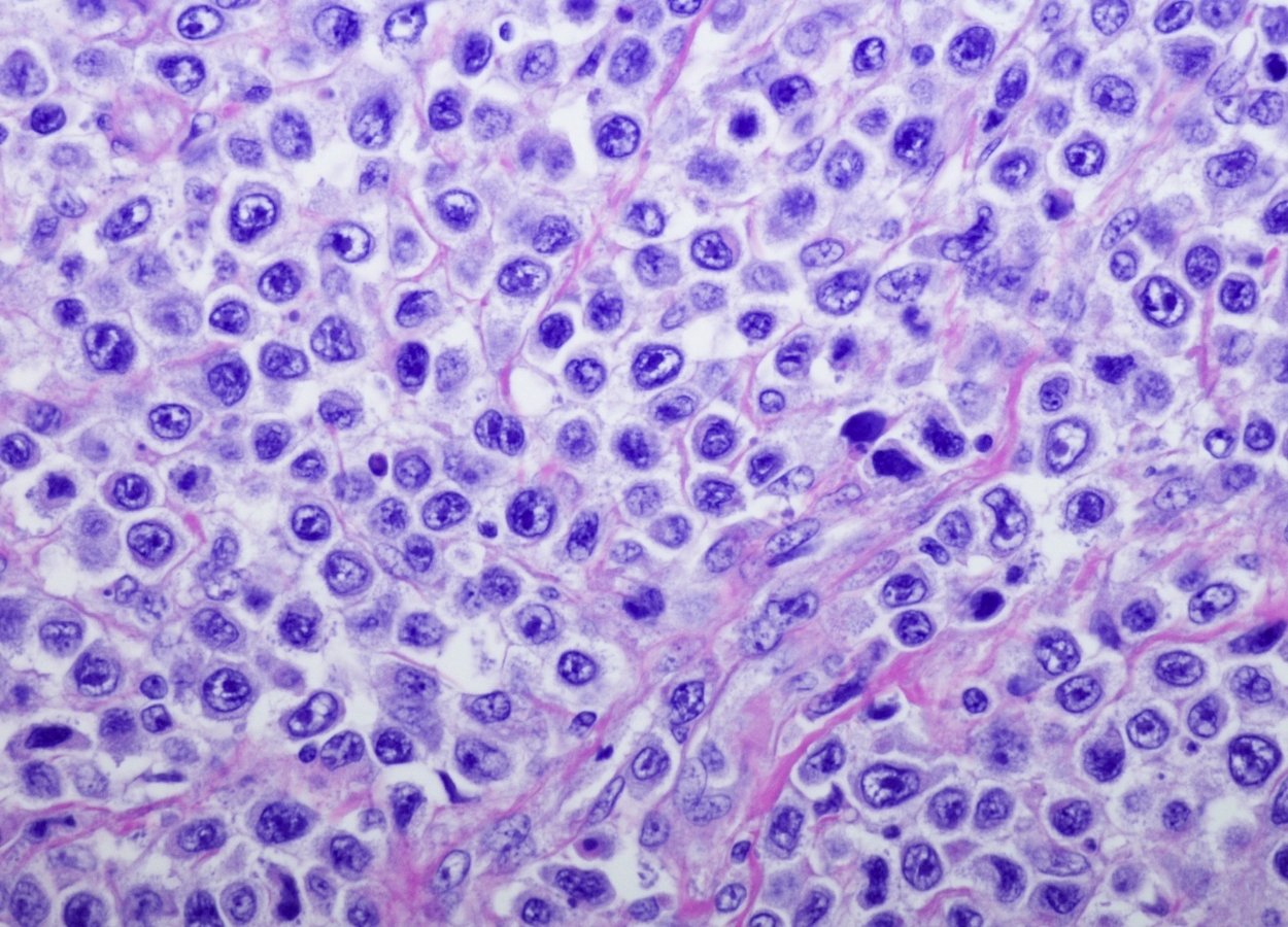 USFDA Approves Bristol Myers Squibb’s Breyanzi (lisocabtagene ...